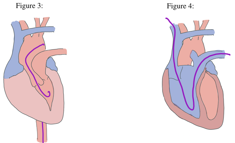 Right Heart Catheterization vs. Left Heart Catheterization vs. Coronary Angiogram — When the ...