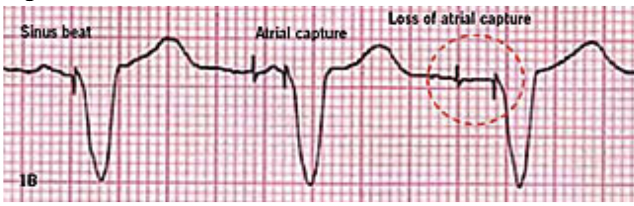 Pacemakers and ICDs — When the Beat Drops: A Resident's Guide to the CCU