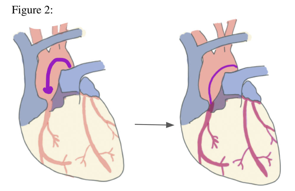 Right Heart Catheterization vs. Left Heart Catheterization vs. Coronary Angiogram — When the ...