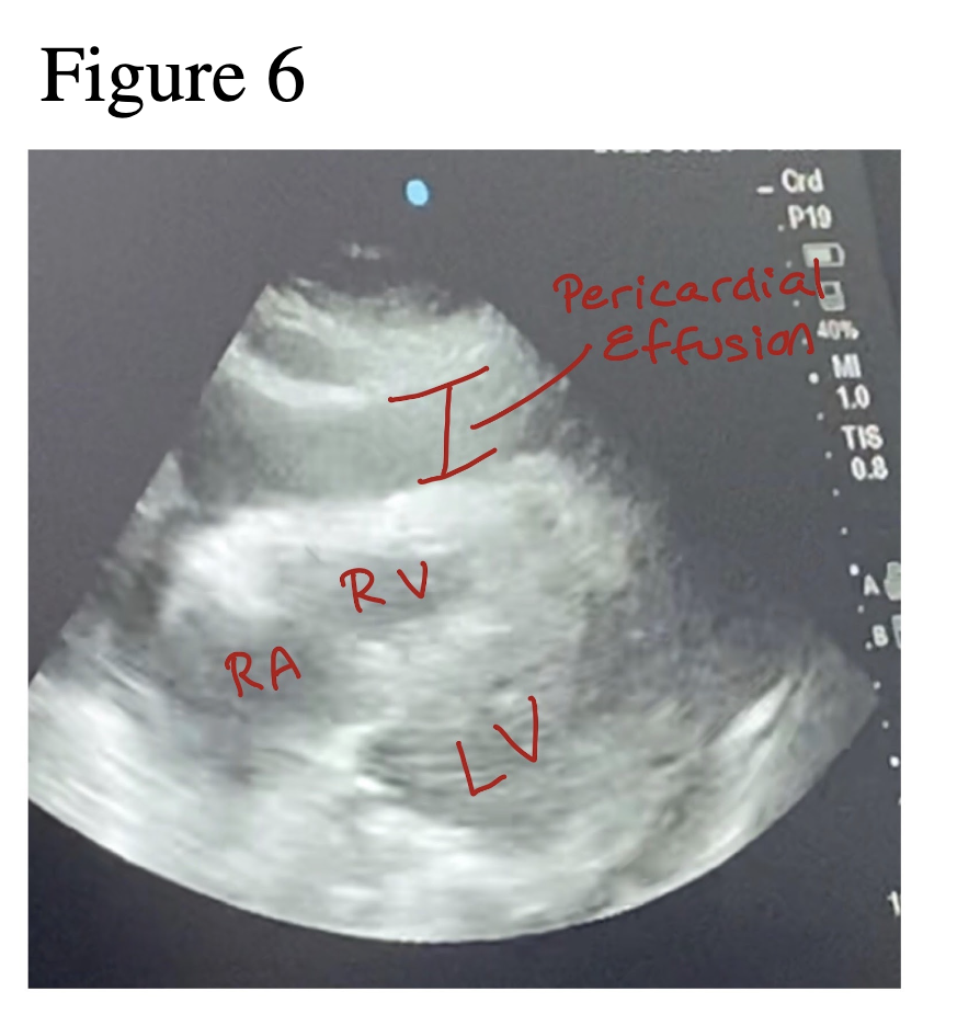 TAVR Complications — When the Beat Drops: A Resident's Guide to the CCU