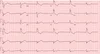 TAVR Complications — When the Beat Drops: A Resident's Guide to the CCU
