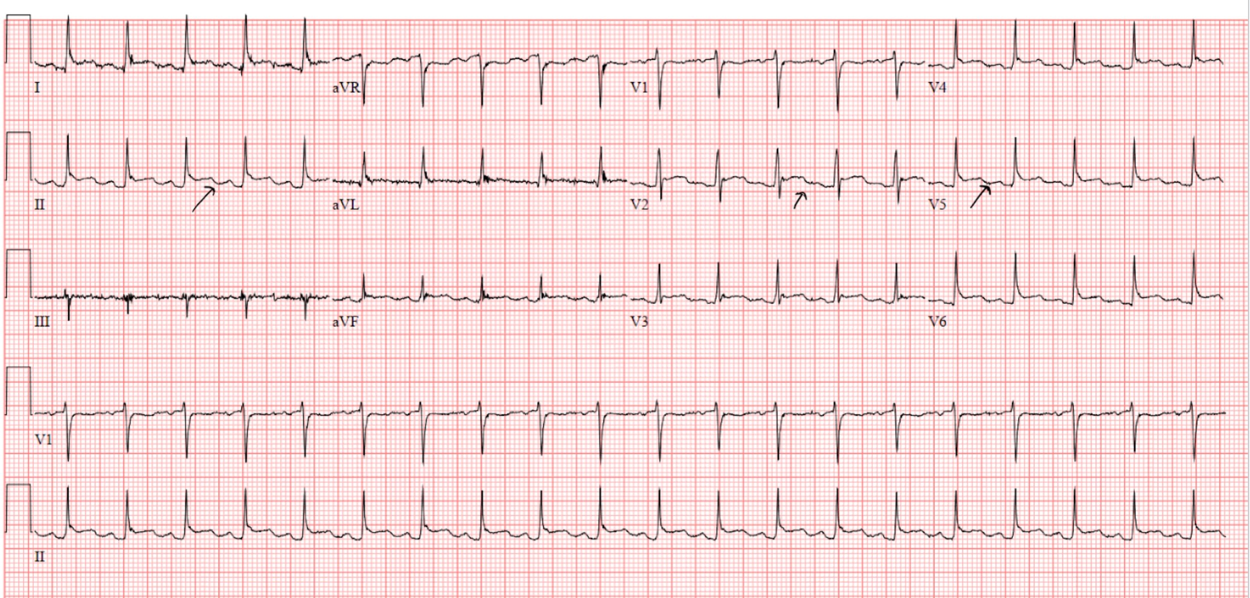 Pericarditis — When the Beat Drops: A Resident's Guide to the CCU