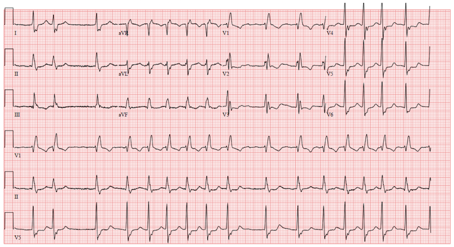 TAVR Complications — When the Beat Drops: A Resident's Guide to the CCU