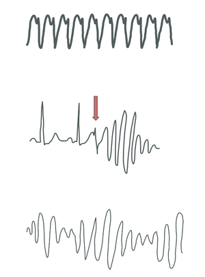 Wide Complex Tachycardia — When the Beat Drops: A Resident's Guide to ...