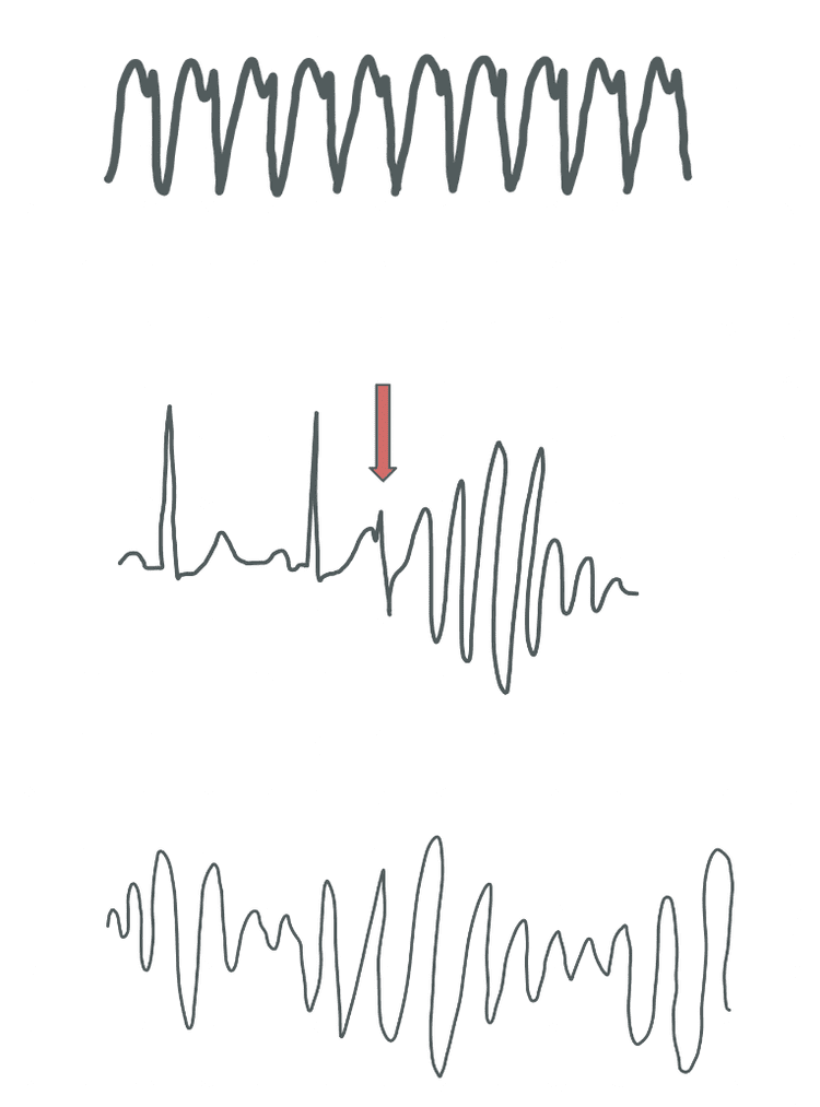 Wide Complex Tachycardia — When the Beat Drops: A Resident's Guide to ...