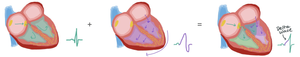 SVT: AVRT vs AVRNT — When the Beat Drops: A Resident's Guide to the CCU