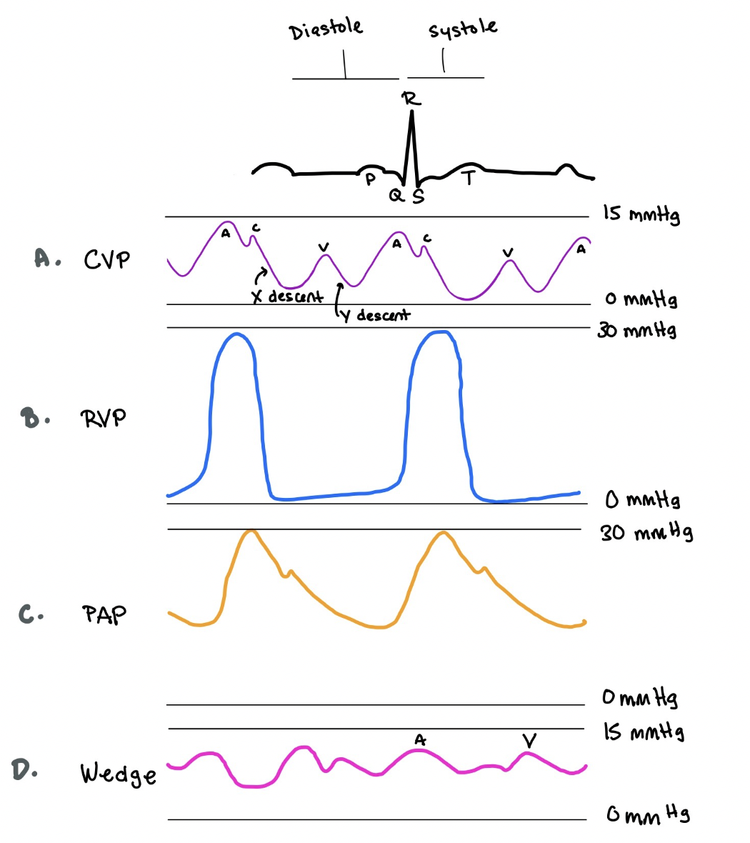 Right Heart Catheterization vs. Left Heart Catheterization vs. Coronary ...