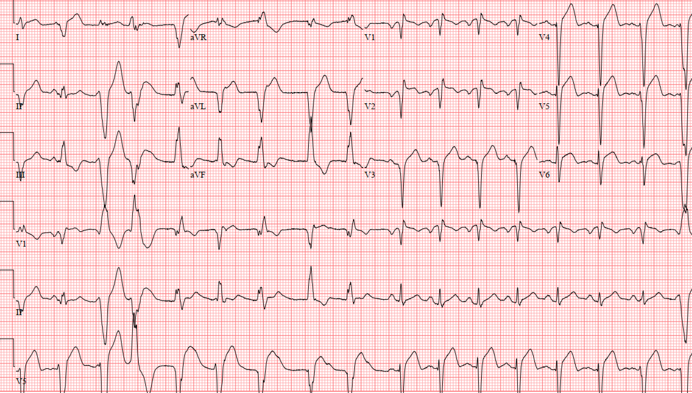 Myocardial Infarction (MI) Complications — When the Beat Drops: A ...
