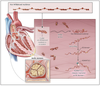 Aortic Stenosis and Heyde’s Syndrome — When the Beat Drops: A Resident ...