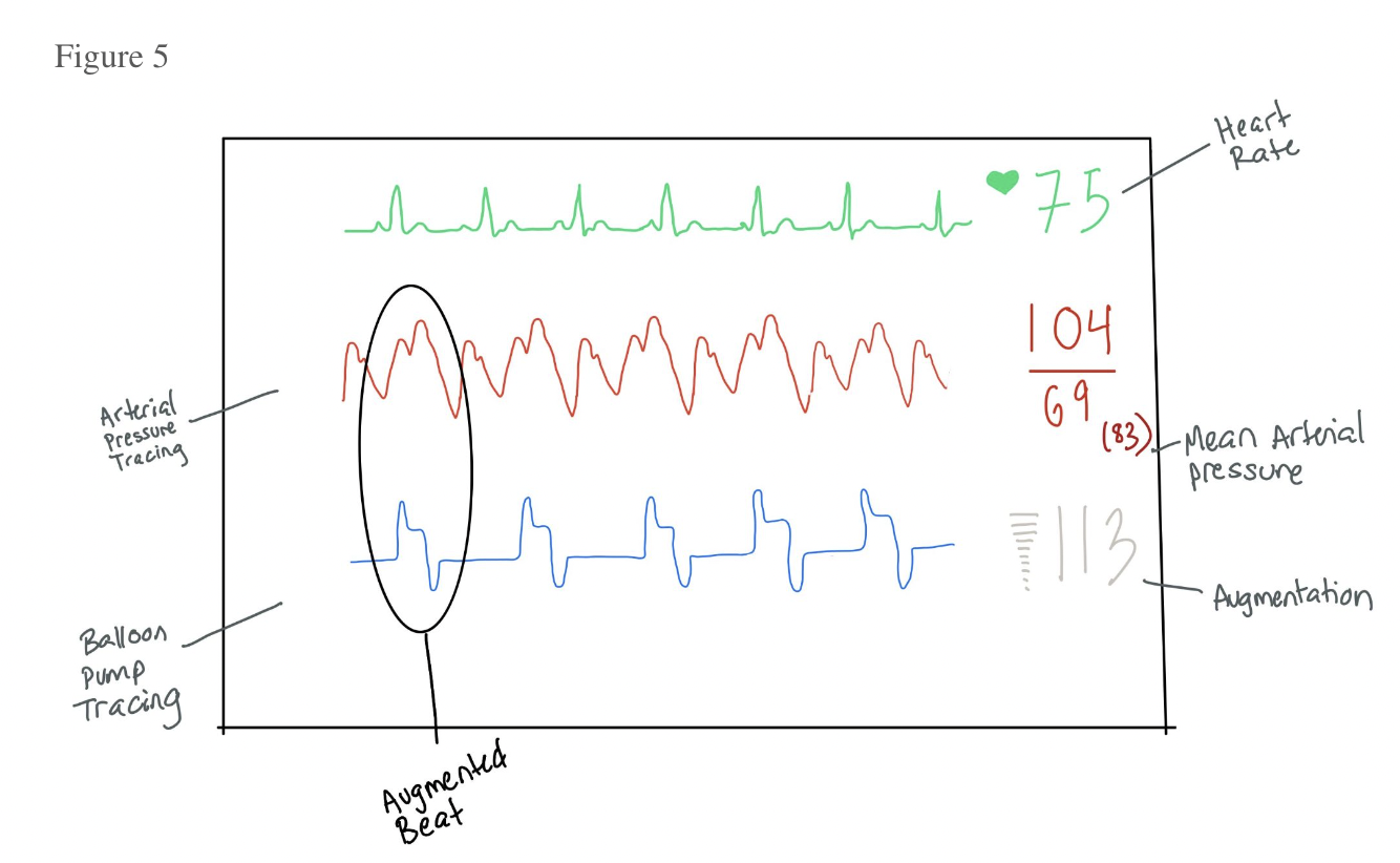 Mechanical Support: Impella and Balloon Pump — When the Beat Drops: A ...