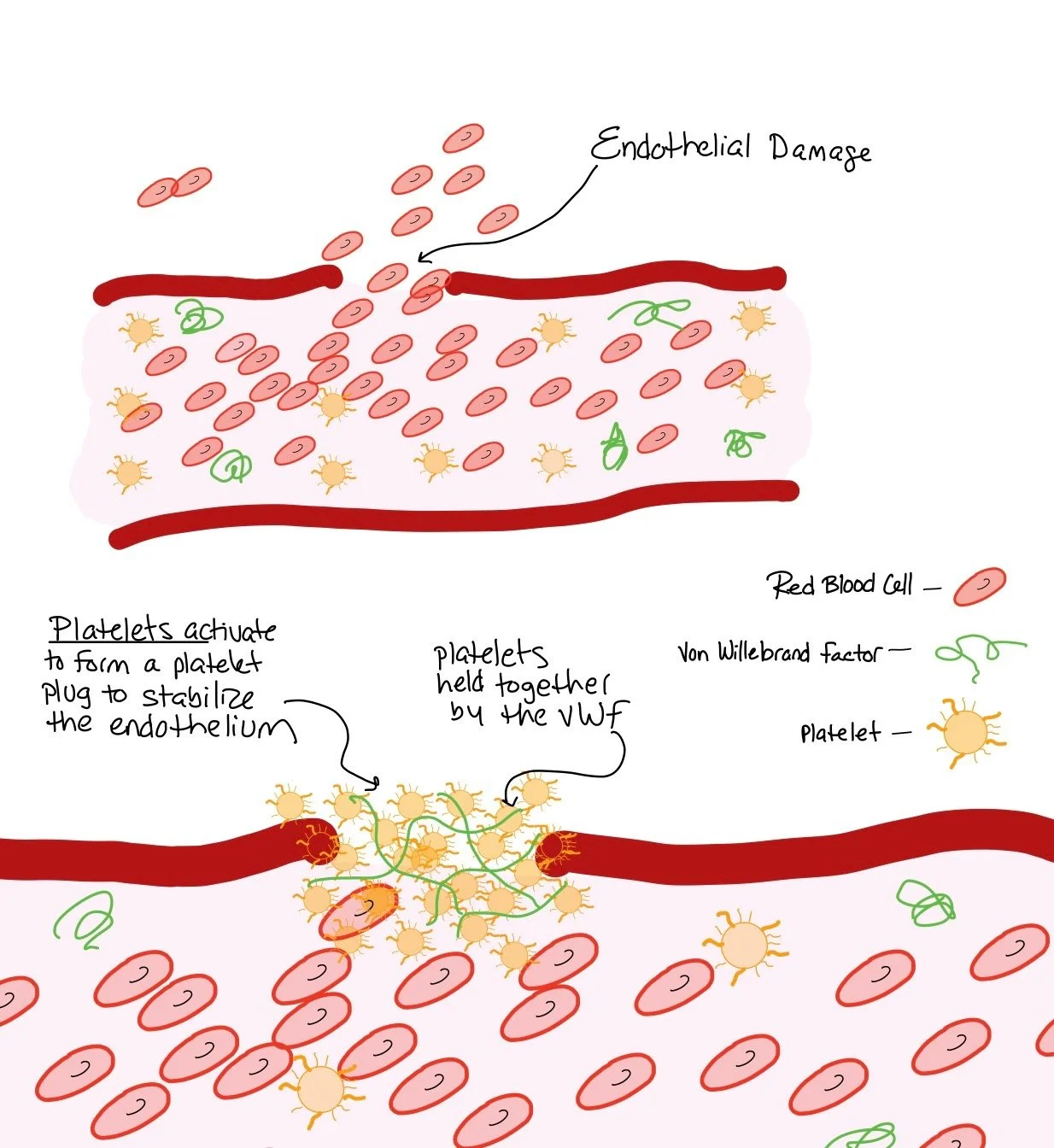 Aortic Stenosis and Heyde’s Syndrome — When the Beat Drops: A Resident ...