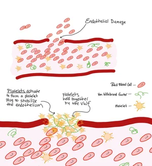 Aortic Stenosis and Heyde’s Syndrome — When the Beat Drops: A Resident ...