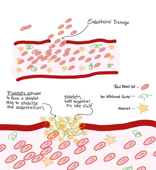 Aortic Stenosis and Heyde’s Syndrome — When the Beat Drops: A Resident ...