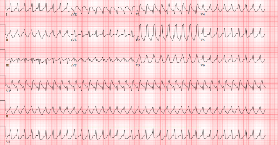 Wide Complex Tachycardia — When the Beat Drops: A Resident's Guide to ...