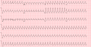 Wide Complex Tachycardia — When the Beat Drops: A Resident's Guide to ...