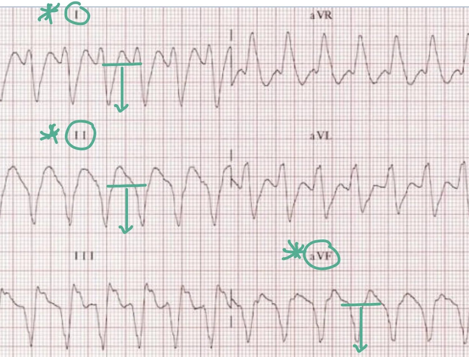 Wide Complex Tachycardia — When the Beat Drops: A Resident's Guide to ...