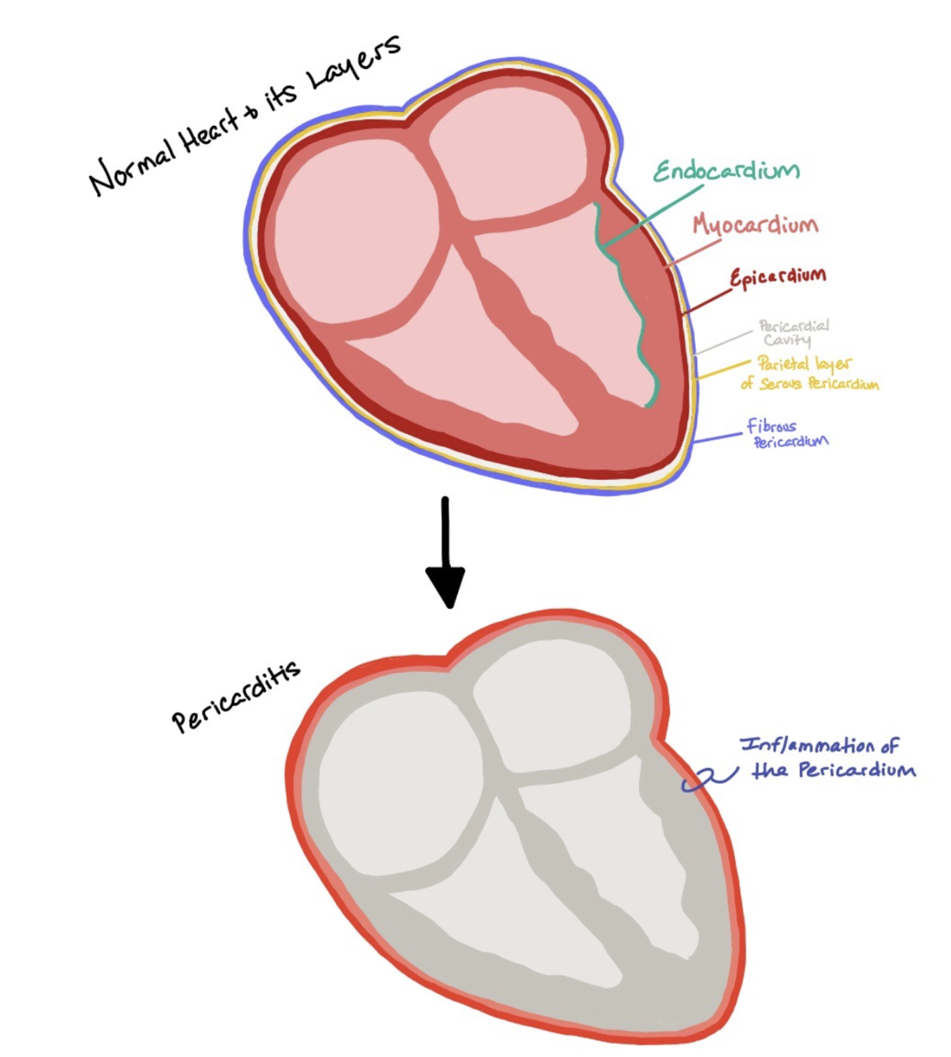 Pericarditis — When the Beat Drops: A Resident's Guide to the CCU