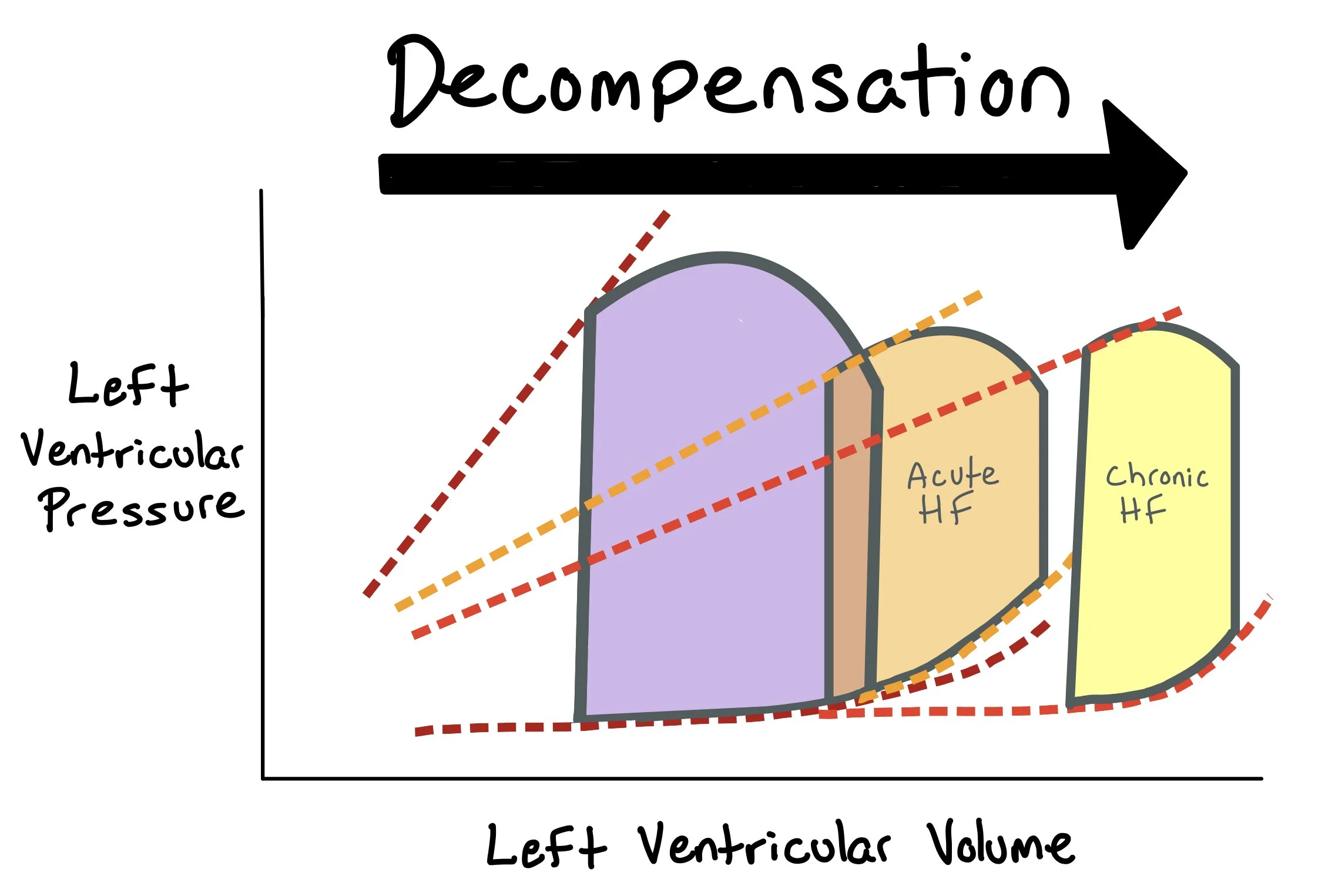 Cardiogenic Shock — When the Beat Drops: A Resident's Guide to the CCU