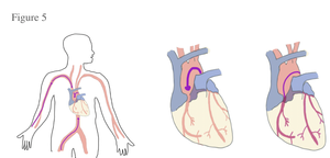 Right Heart Catheterization vs. Left Heart Catheterization vs. Coronary ...