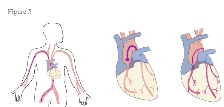 Right Heart Catheterization vs. Left Heart Catheterization vs. Coronary ...