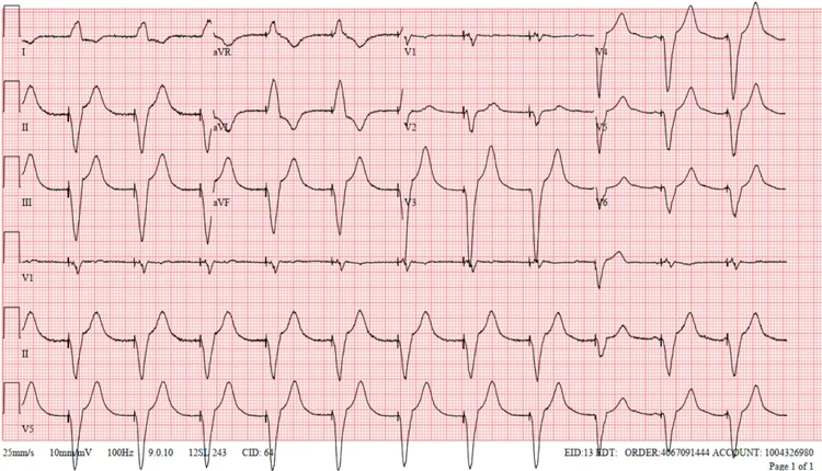TAVR Complications — When the Beat Drops: A Resident's Guide to the CCU