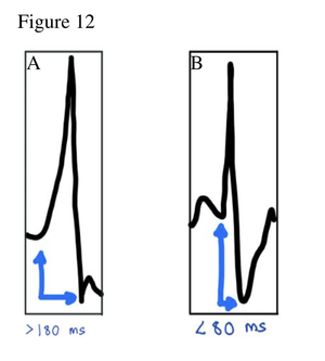 Wide Complex Tachycardia — When the Beat Drops: A Resident's Guide to ...