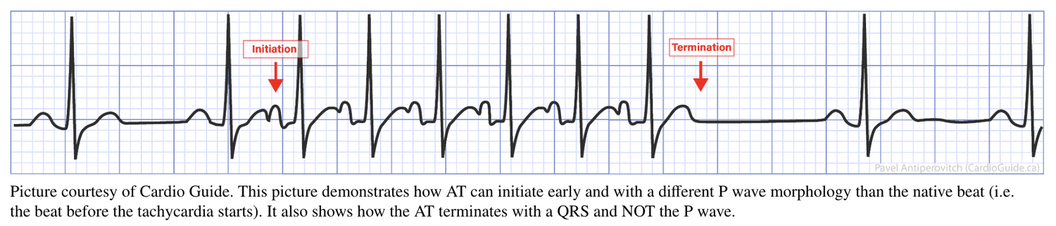 SVT: AVRT vs AVRNT — When the Beat Drops: A Resident's Guide to the CCU
