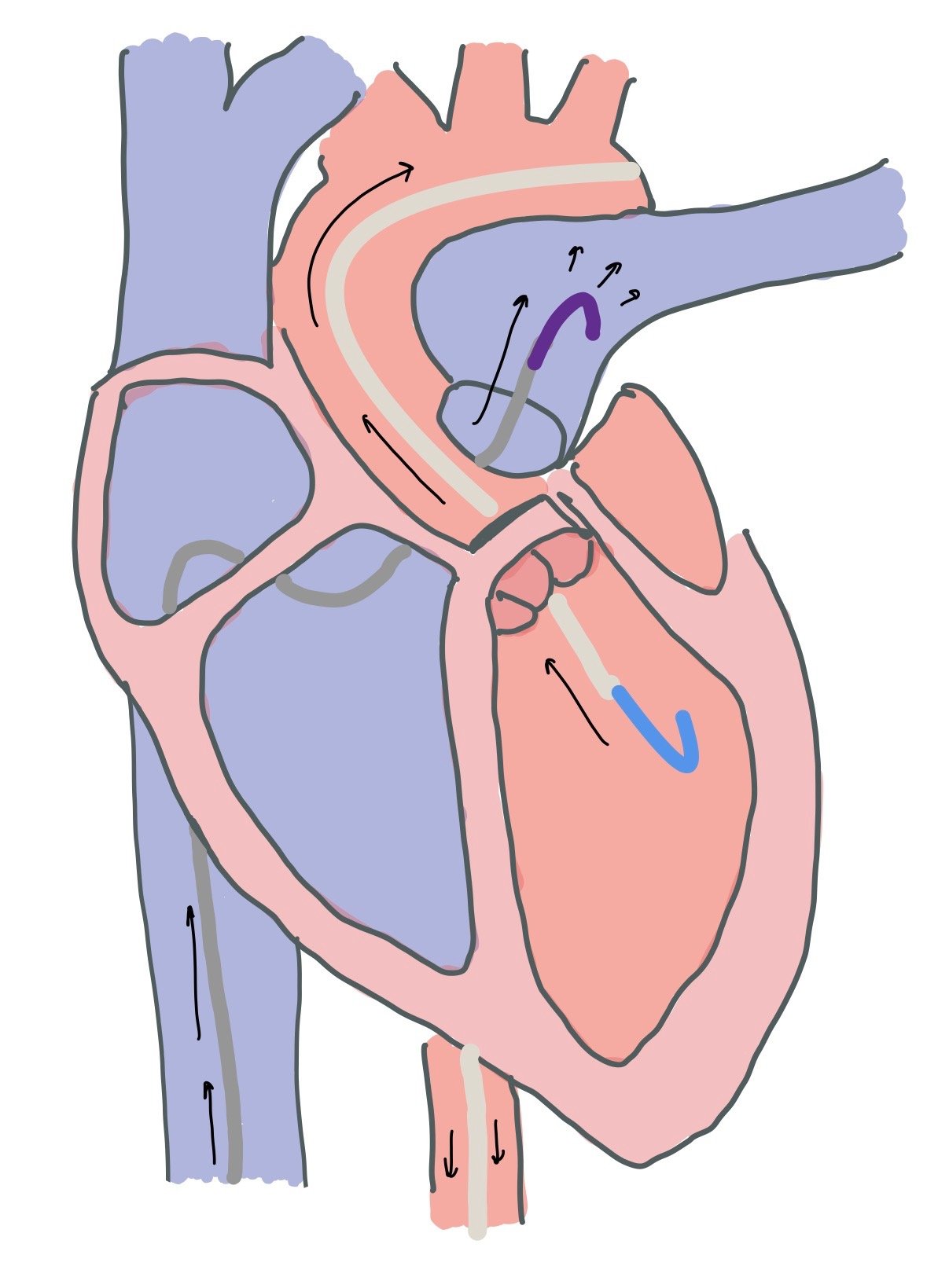 Mechanical Support: Impella and Balloon Pump — When the Beat Drops: A ...