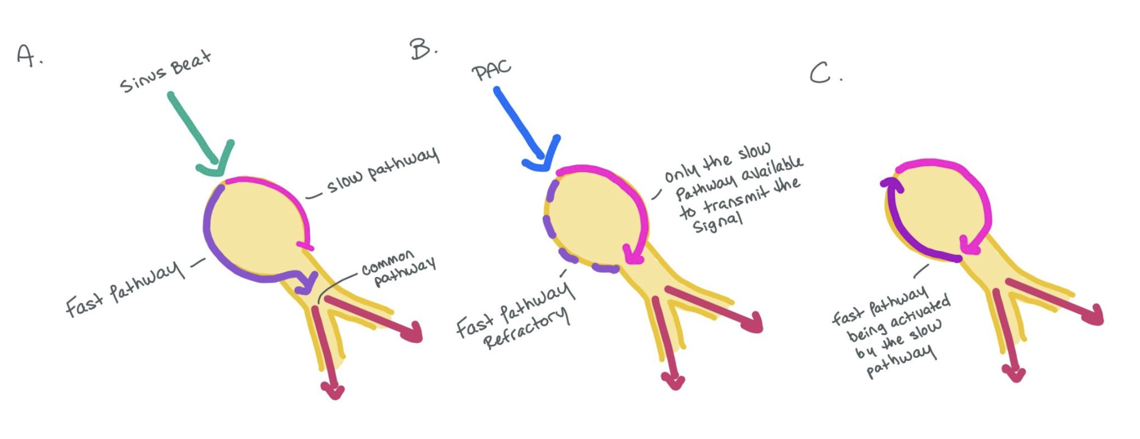 SVT: AVRT vs AVRNT — When the Beat Drops: A Resident's Guide to the CCU