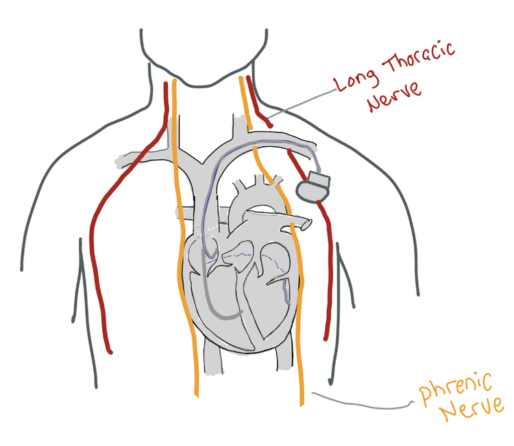Pacemakers and ICDs — When the Beat Drops: A Resident's Guide to the CCU