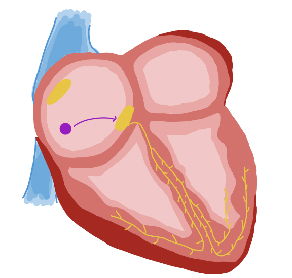 SVT: AVRT vs AVRNT — When the Beat Drops: A Resident's Guide to the CCU