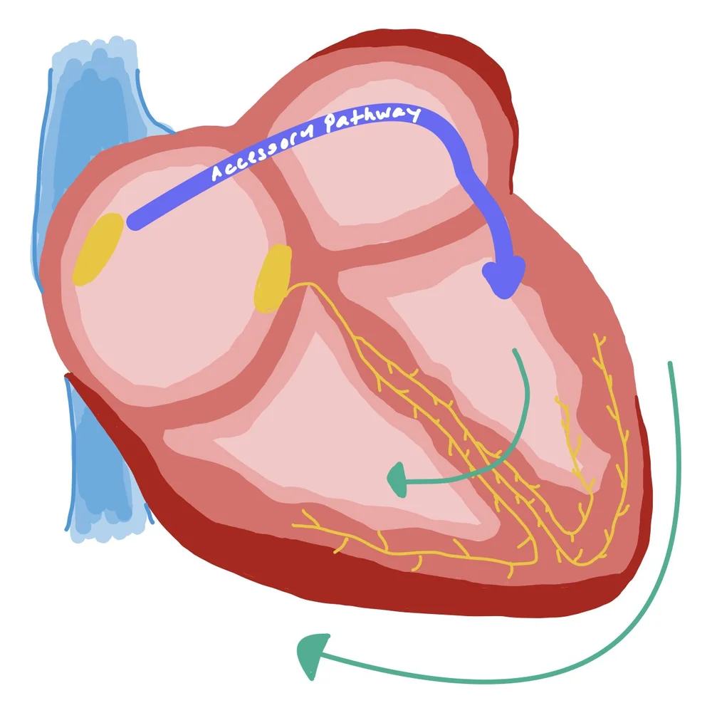 Wide Complex Tachycardia — When the Beat Drops: A Resident's Guide to ...