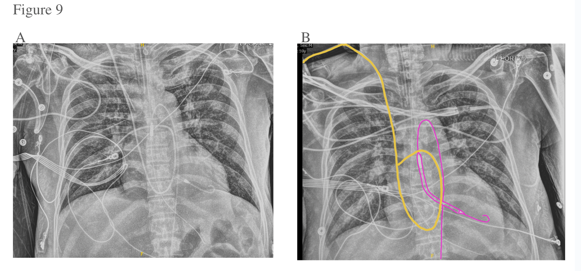 Mechanical Support: Impella and Balloon Pump — When the Beat Drops: A ...