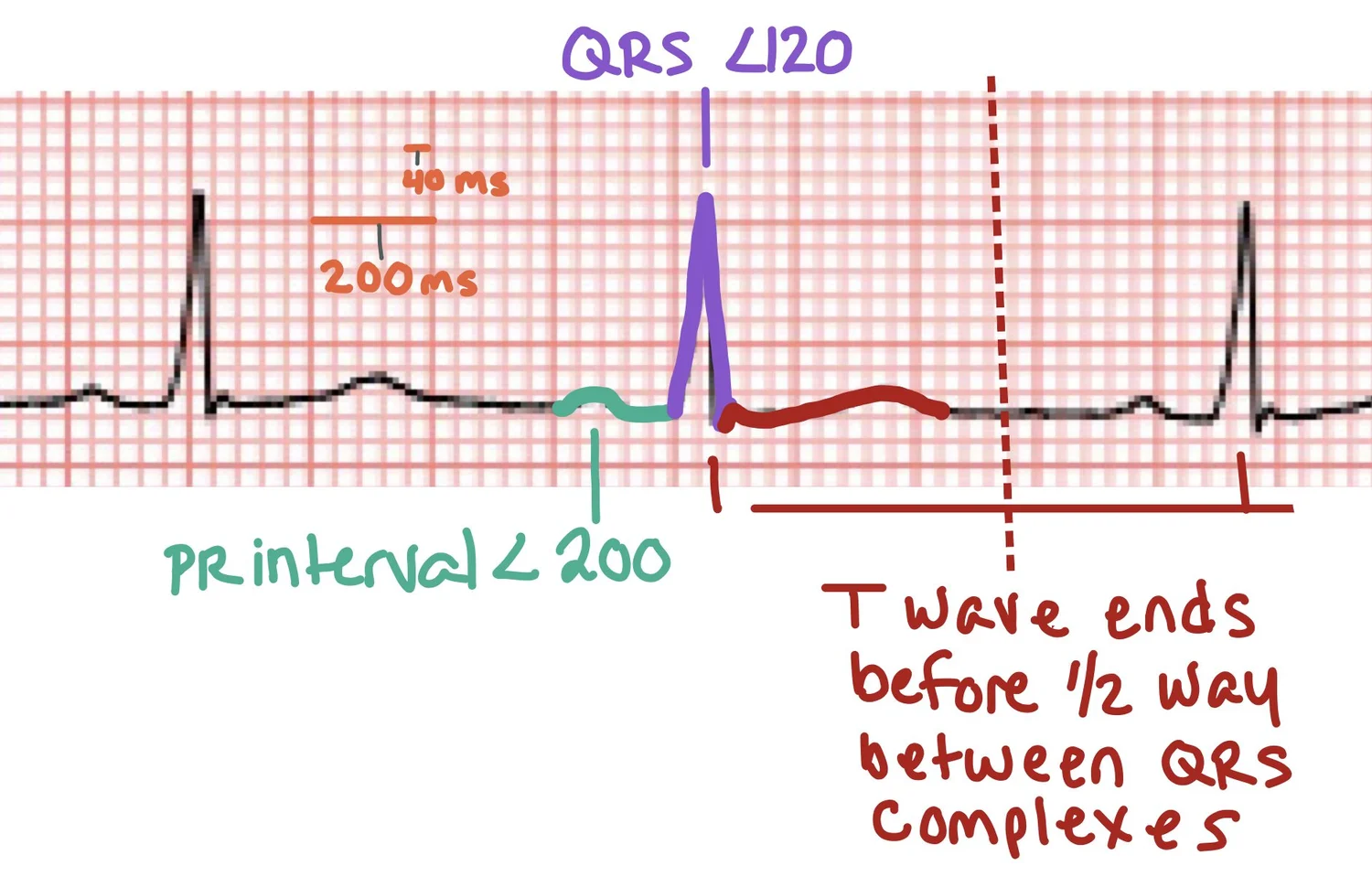 How to Read EKGs — When the Beat Drops: A Resident's Guide to the CCU