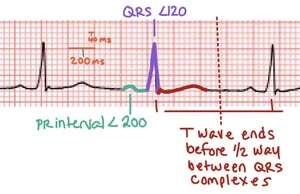 How to Read EKGs — When the Beat Drops: A Resident's Guide to the CCU
