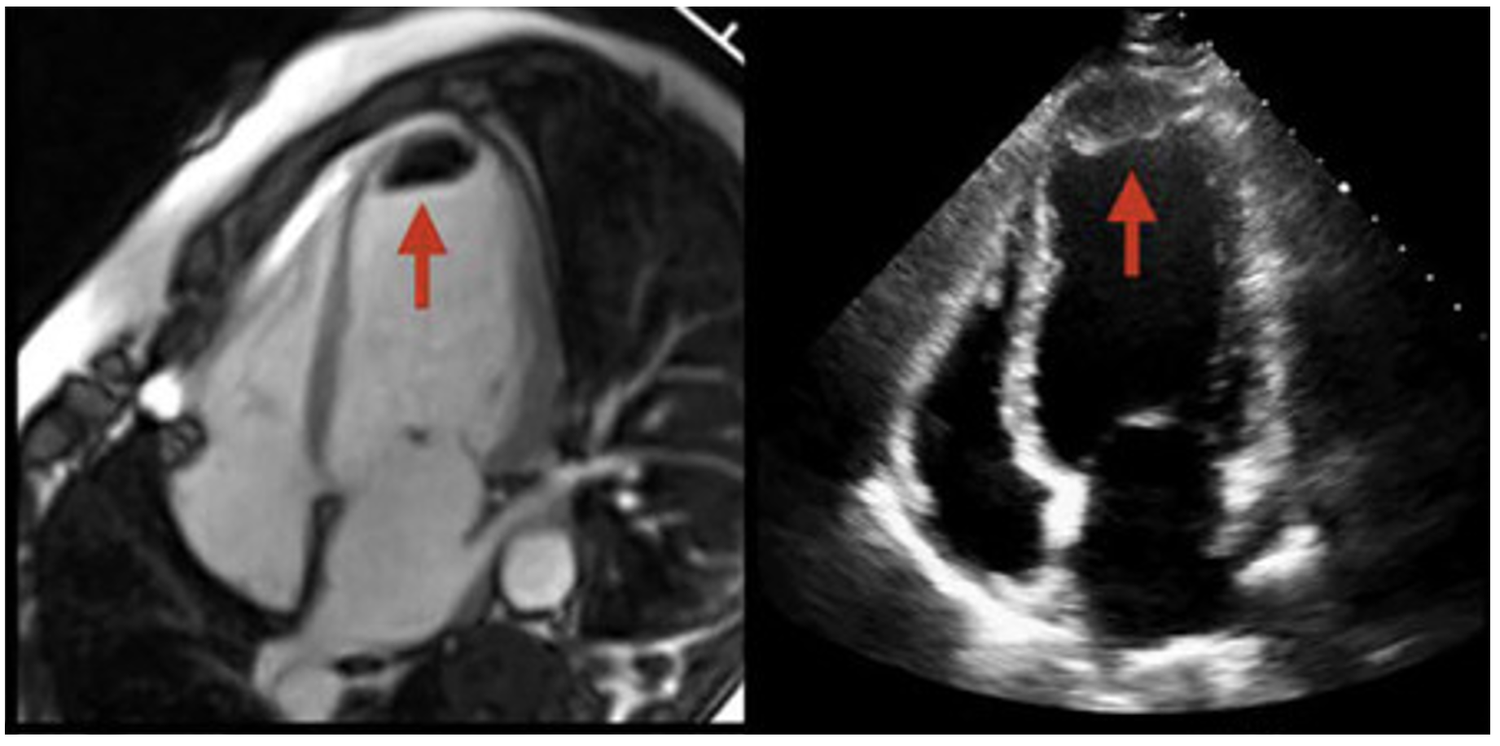 Left Ventricular Thrombus — When the Beat Drops: A Resident's Guide to ...