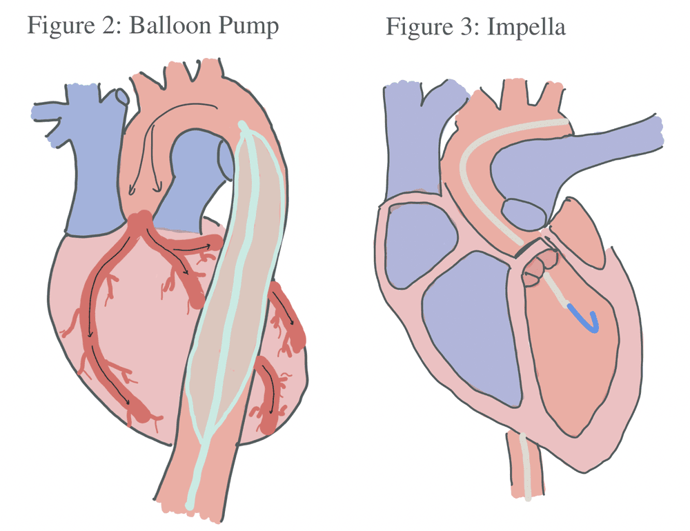 Mechanical Support: Impella and Balloon Pump — When the Beat Drops: A Resident's Guide to the CCU