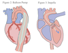 Mechanical Support: Impella and Balloon Pump — When the Beat Drops: A ...