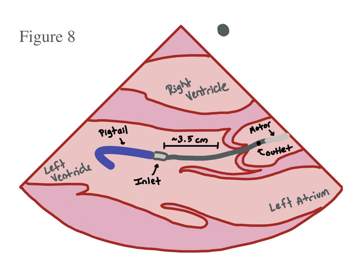 Mechanical Support: Impella and Balloon Pump — When the Beat Drops: A ...