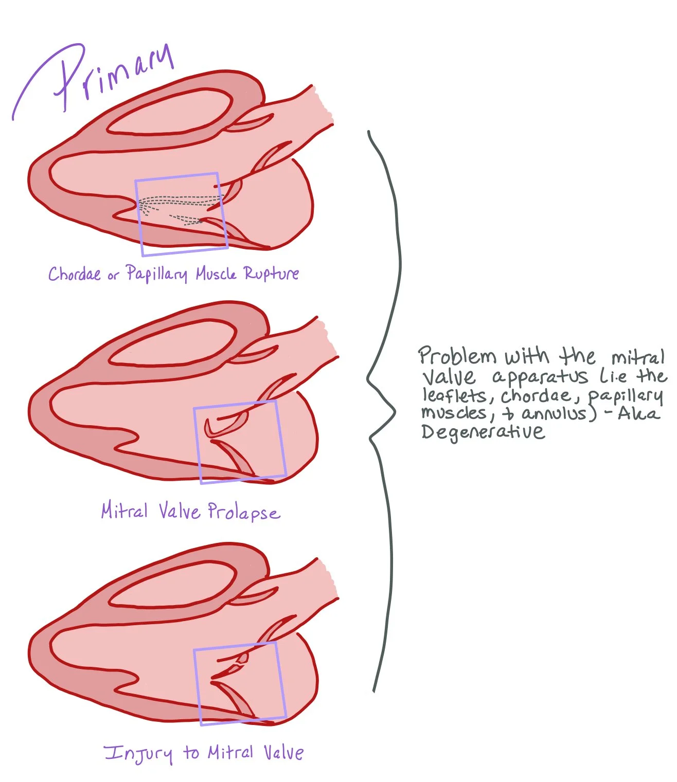 Mitral Regurgitation and Replacement Complications — When the Beat ...