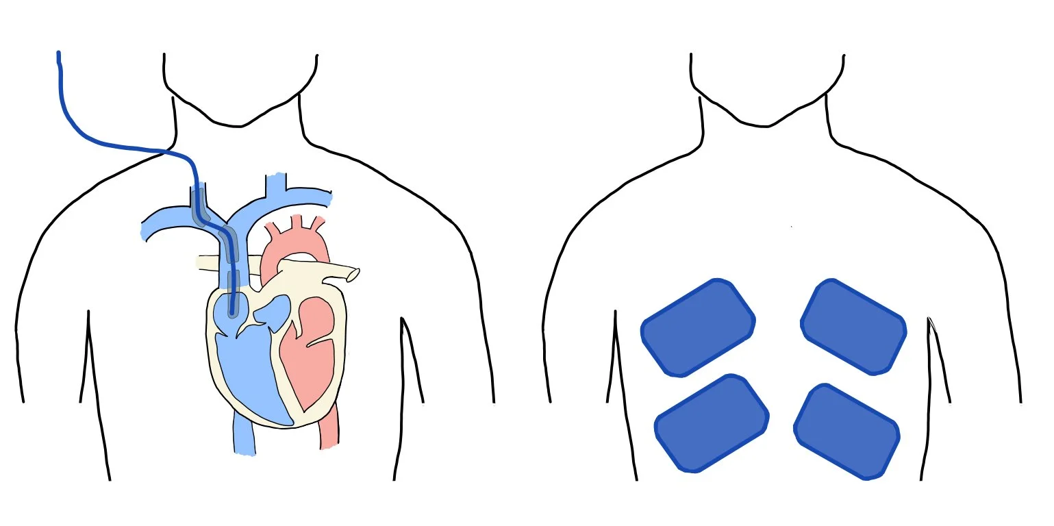 Targeted Temperature Management (TTM) — When the Beat Drops: A Resident ...