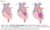 Right Heart Catheterization vs. Left Heart Catheterization vs. Coronary ...