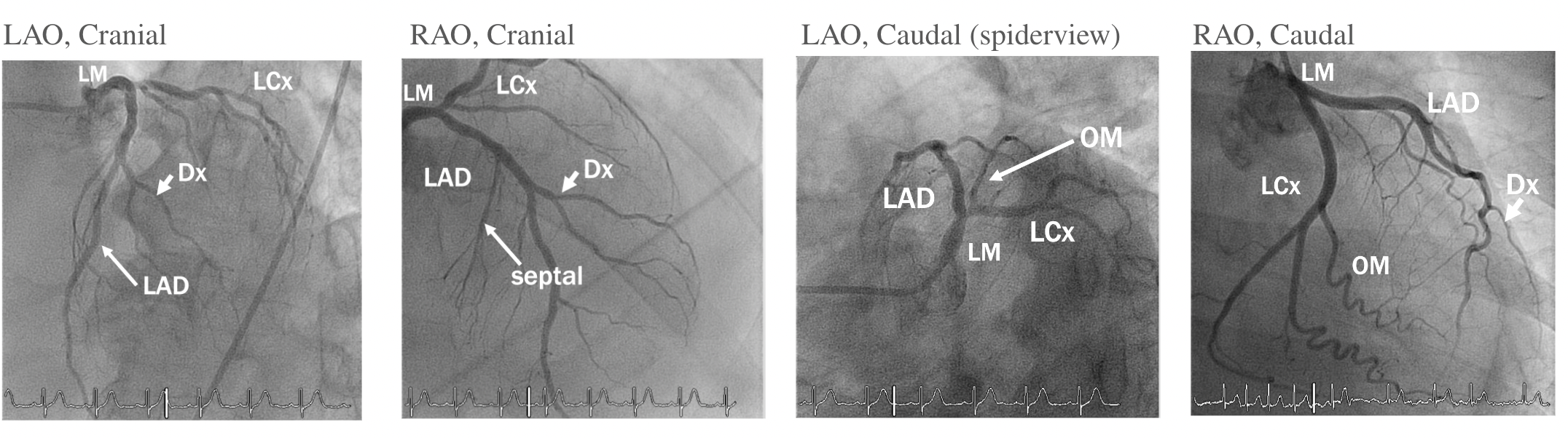 Right Heart Catheterization vs. Left Heart Catheterization vs. Coronary Angiogram — When the ...