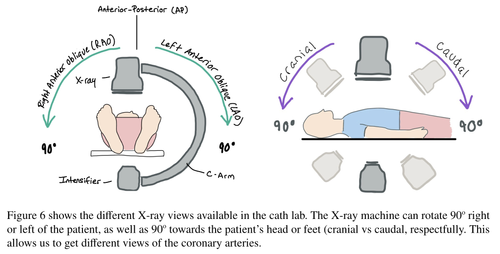 Right Heart Catheterization vs. Left Heart Catheterization vs. Coronary ...