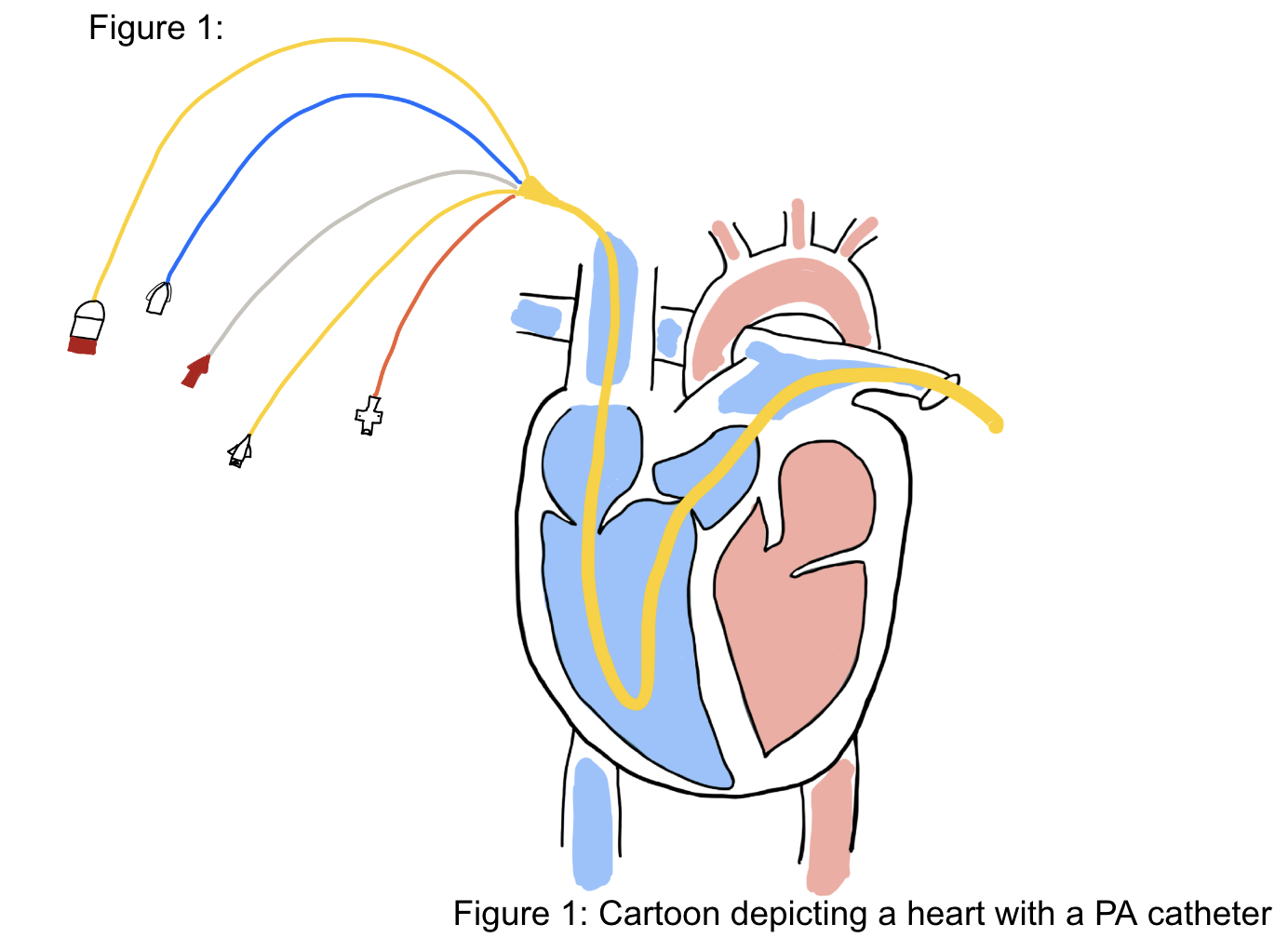 Pulmonary Artery Catheters / Swans — When the Beat Drops: A Resident's ...