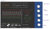 Mechanical Support: Impella and Balloon Pump — When the Beat Drops: A ...