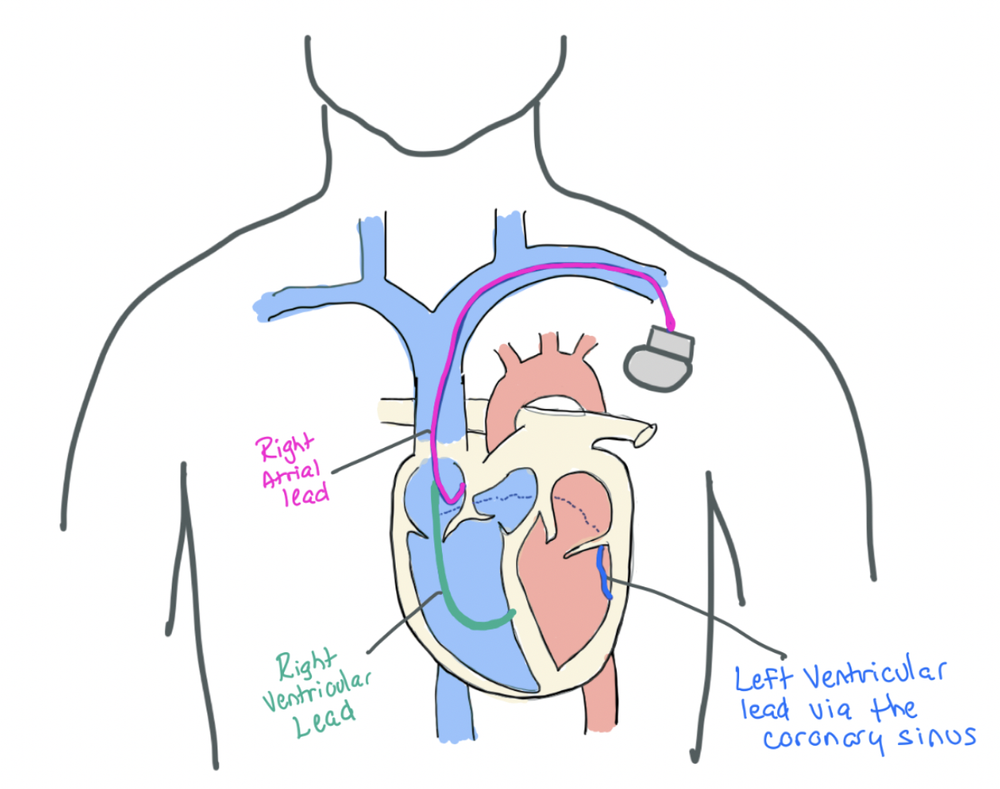 Bradycardia — When the Beat Drops: A Resident's Guide to the CCU