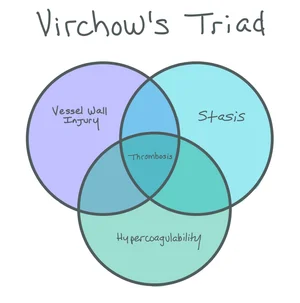 Left Ventricular Thrombus — When the Beat Drops: A Resident's Guide to ...