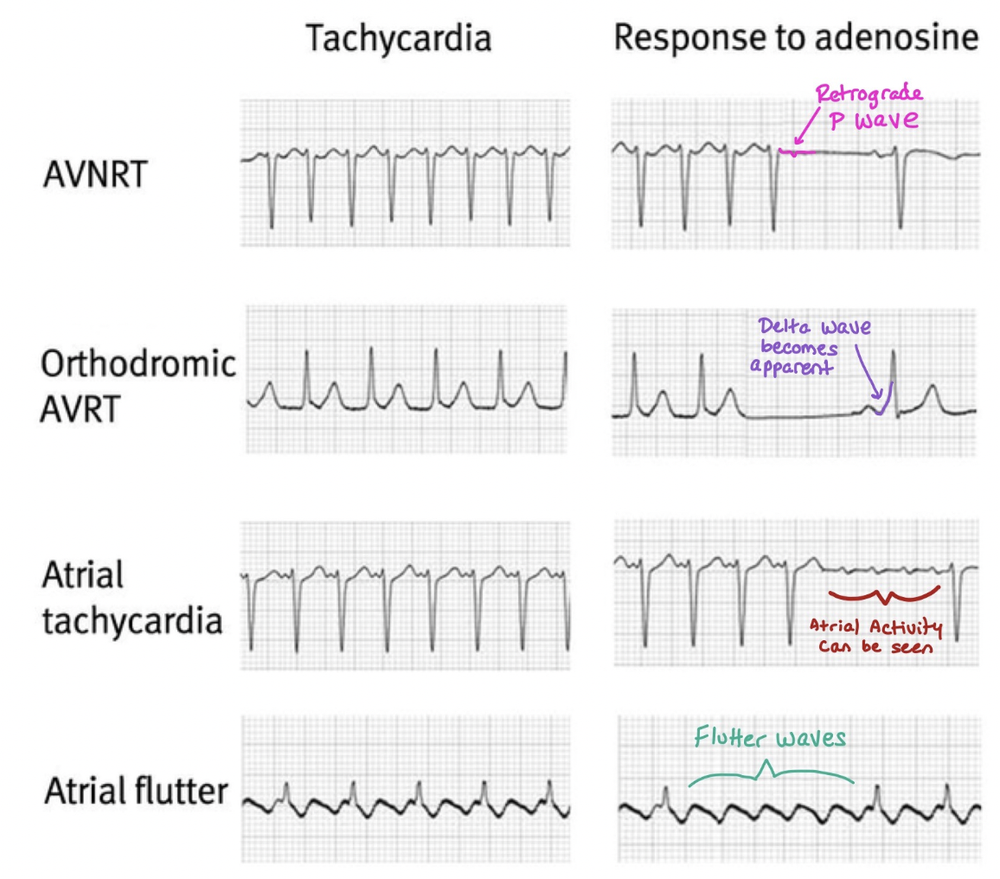SVT: AVRT vs AVRNT — When the Beat Drops: A Resident's Guide to the CCU