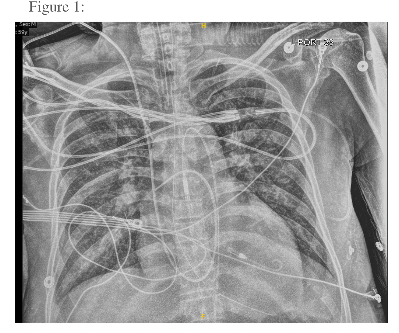 Mechanical Support: Impella and Balloon Pump — When the Beat Drops: A ...